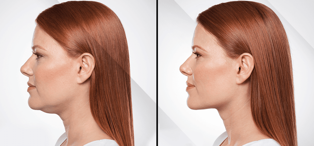 Lipo de papada: procedimento elimina gordurinha indesejada - Plena Mulher